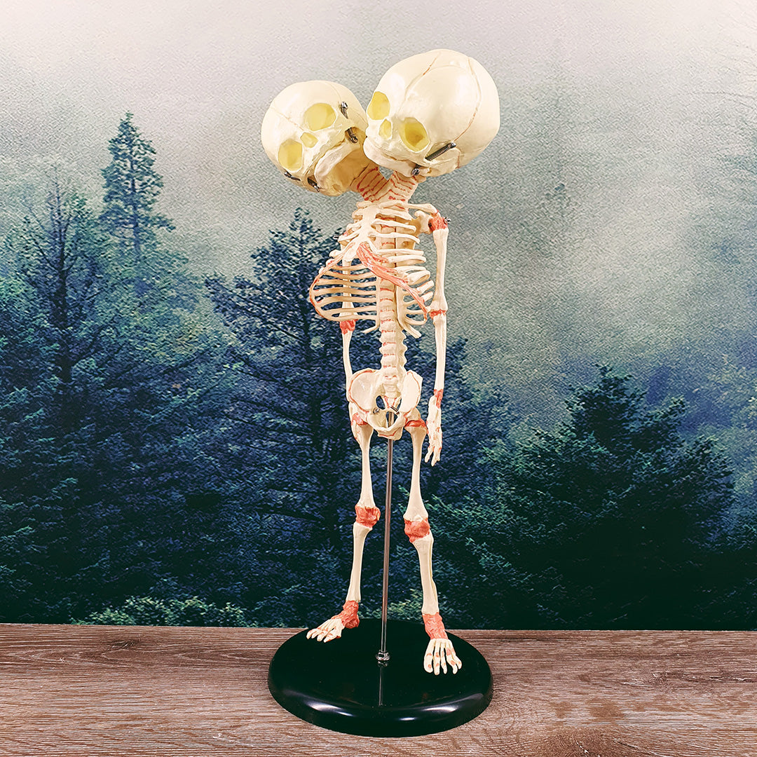 Fetal Conjoined Twins Anatomical Model
